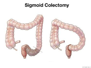 What Is Colon Cancer